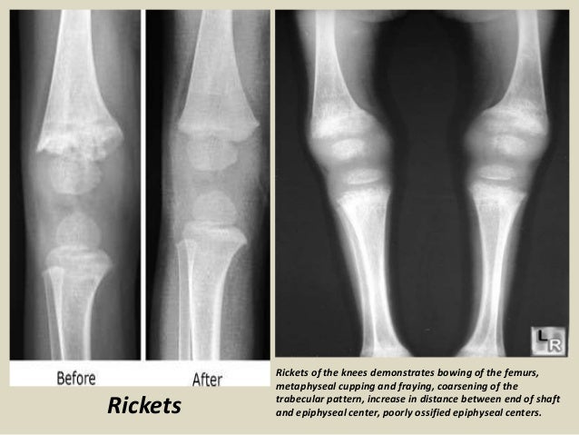 Rickets Disease X Rays