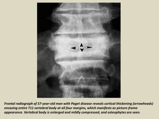 Presentation1.pptx, radiological imaging of paget disease. | PPTX