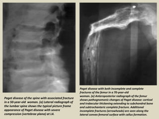 Presentation1.pptx, radiological imaging of paget disease. | PPTX
