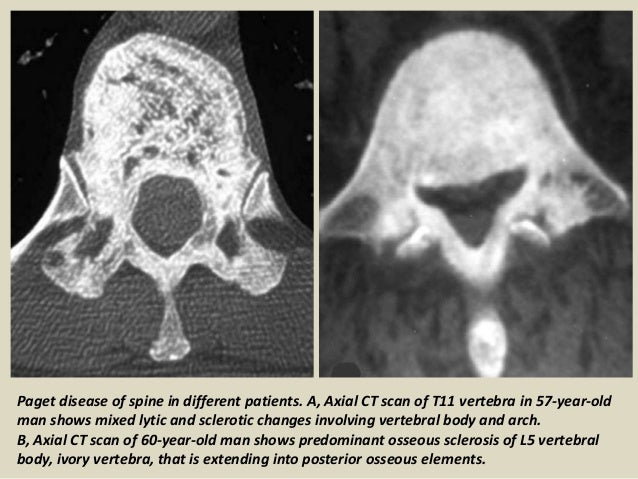 Presentation1.pptx, radiological imaging of paget disease.