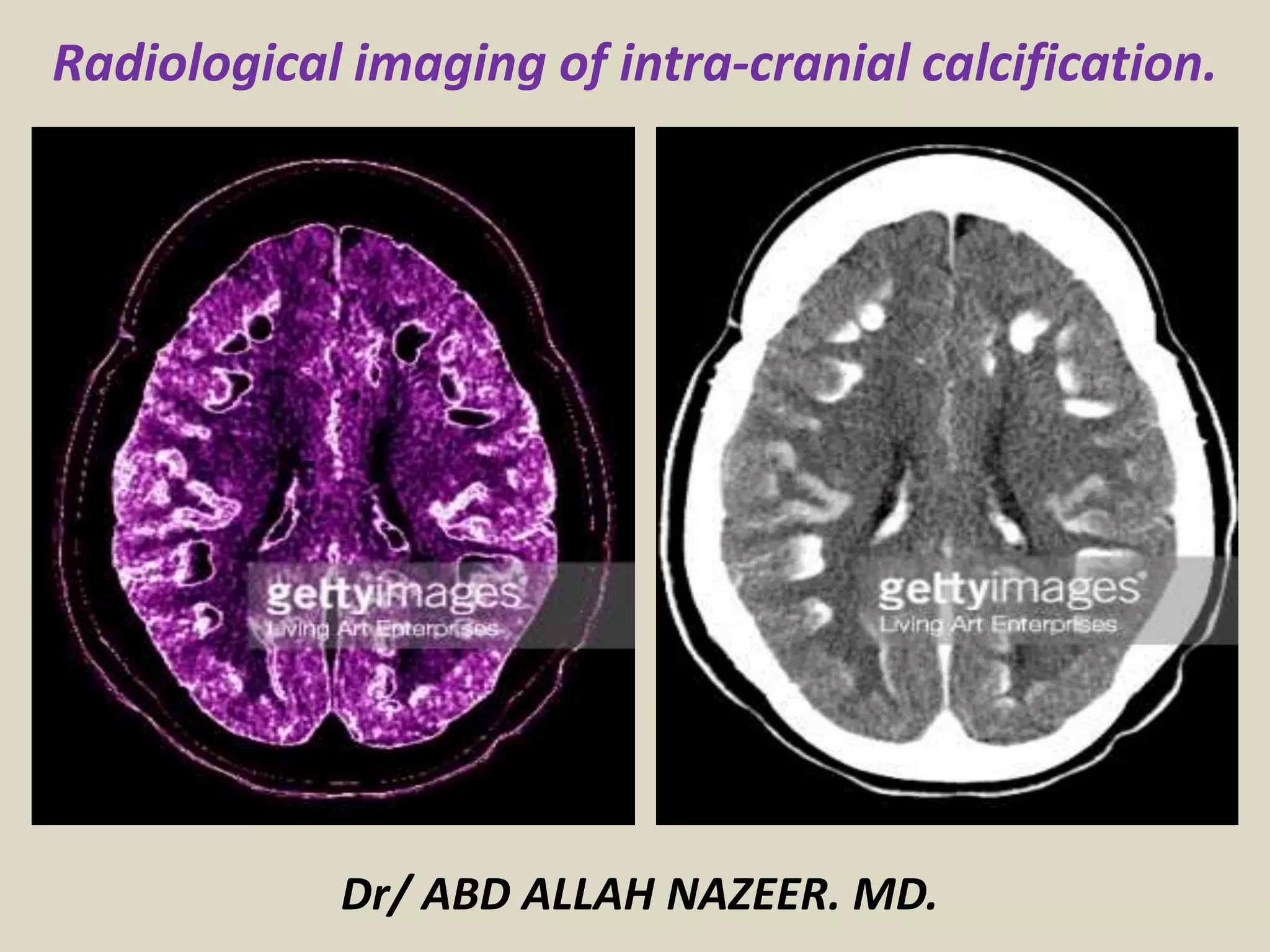 Presentation1.pptx, radiological imaging of intra cranial calcification ...