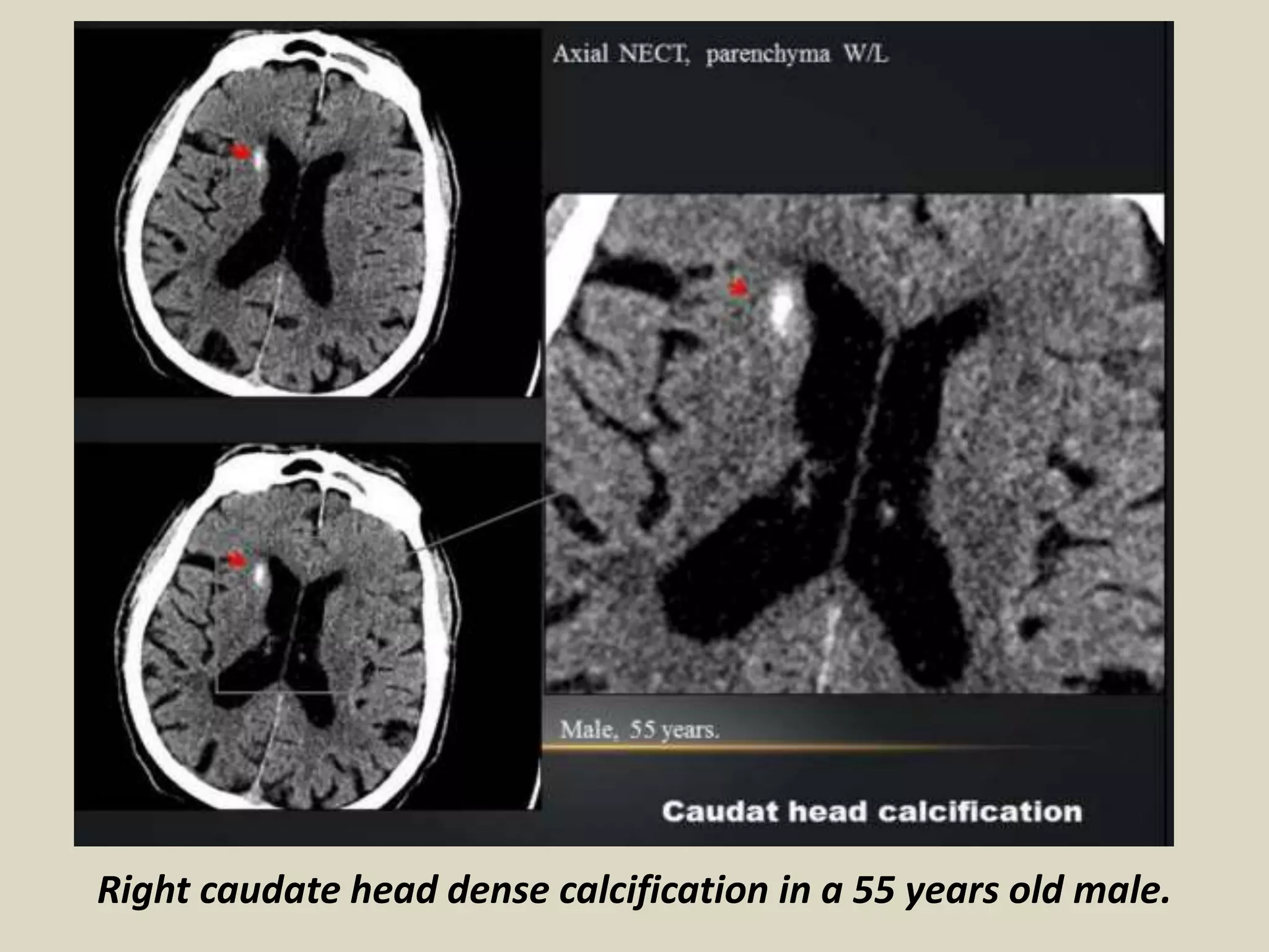 Presentation1.pptx, radiological imaging of intra cranial calcification ...