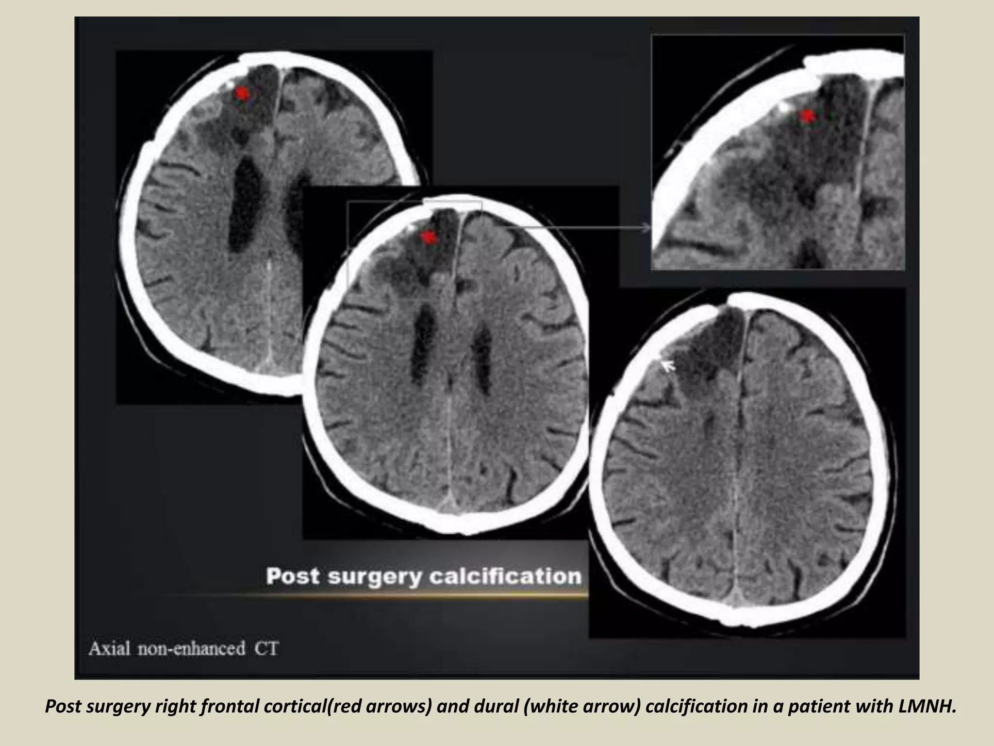 Presentation1.pptx, radiological imaging of intra cranial calcification ...