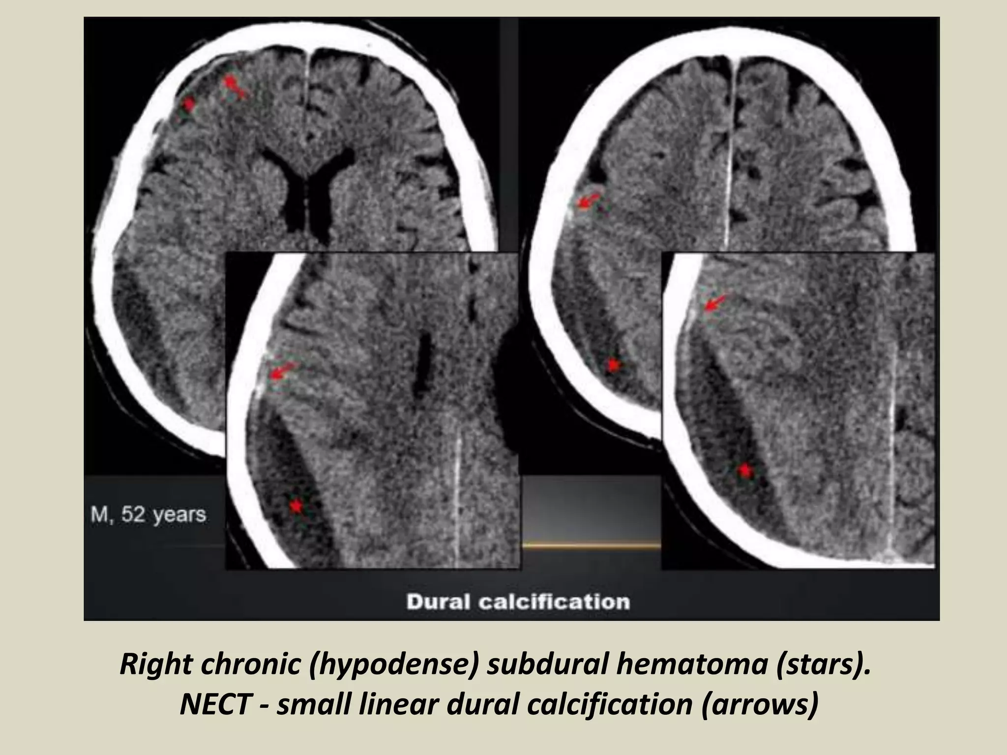 Presentation1.pptx, radiological imaging of intra cranial calcification ...