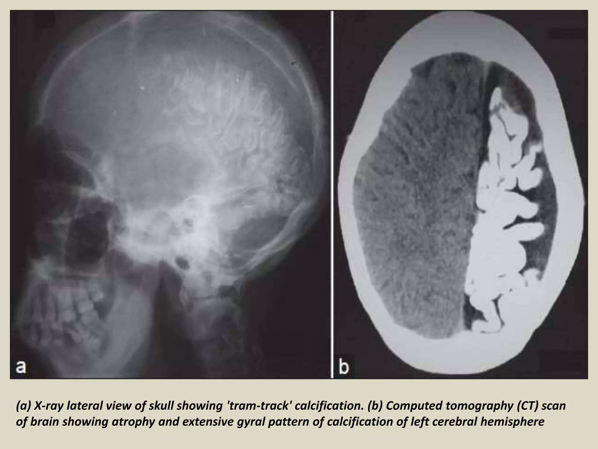 Presentation1.pptx, radiological imaging of intra cranial calcification ...