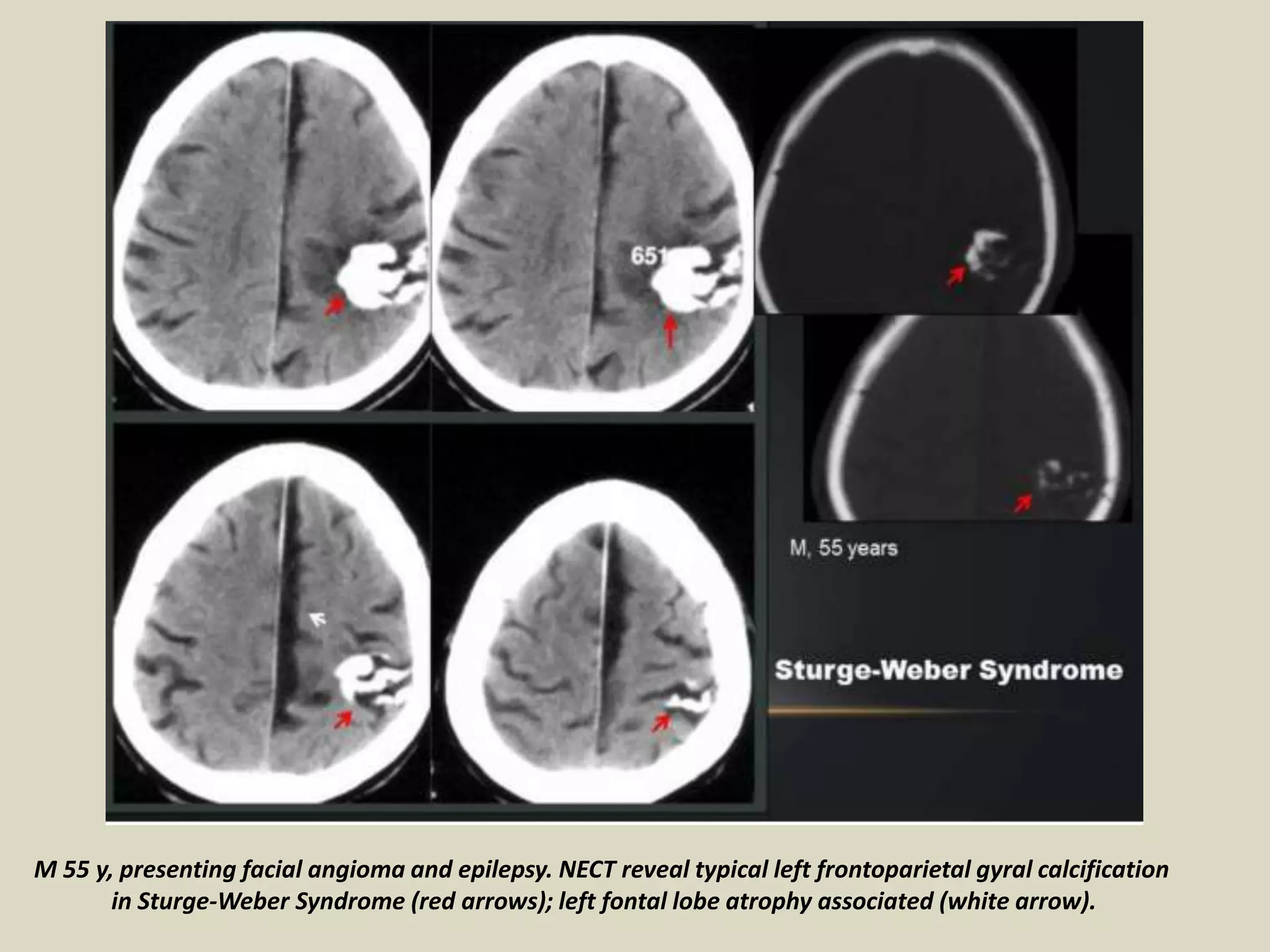 Presentation1.pptx, radiological imaging of intra cranial calcification ...