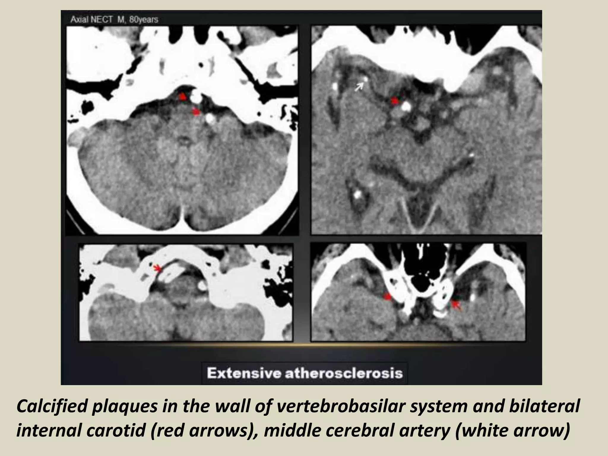 Presentation1.pptx, radiological imaging of intra cranial calcification ...