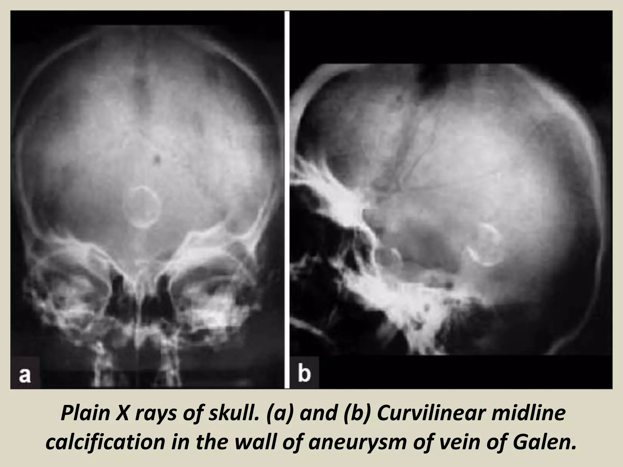Presentation1.pptx, radiological imaging of intra cranial calcification ...