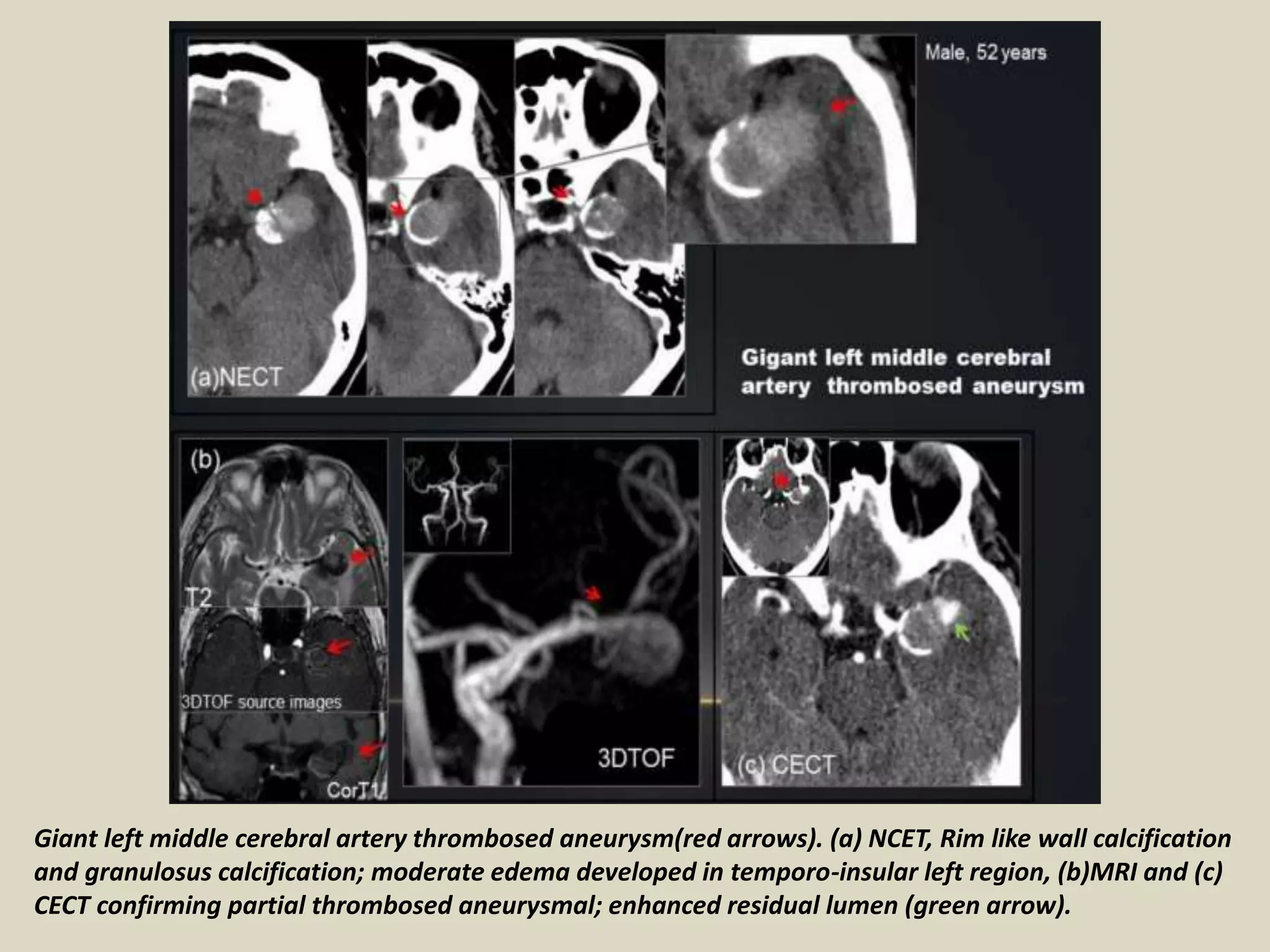 Presentation1.pptx, radiological imaging of intra cranial calcification ...