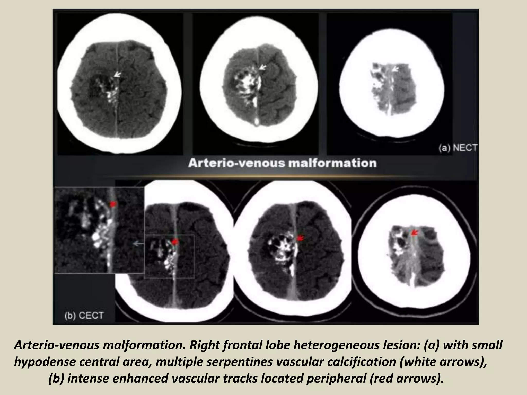 Presentation1.pptx, radiological imaging of intra cranial calcification ...