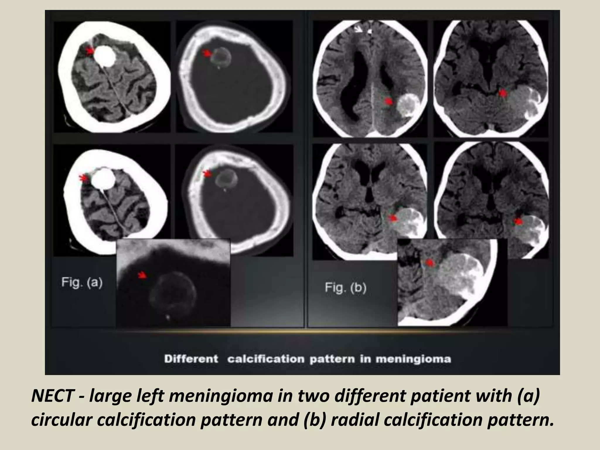 Presentation1.pptx, radiological imaging of intra cranial calcification ...