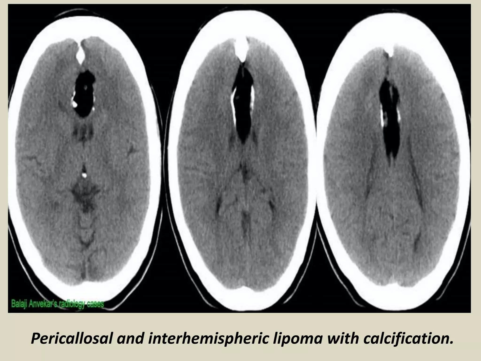 Presentation1.pptx, radiological imaging of intra cranial calcification ...