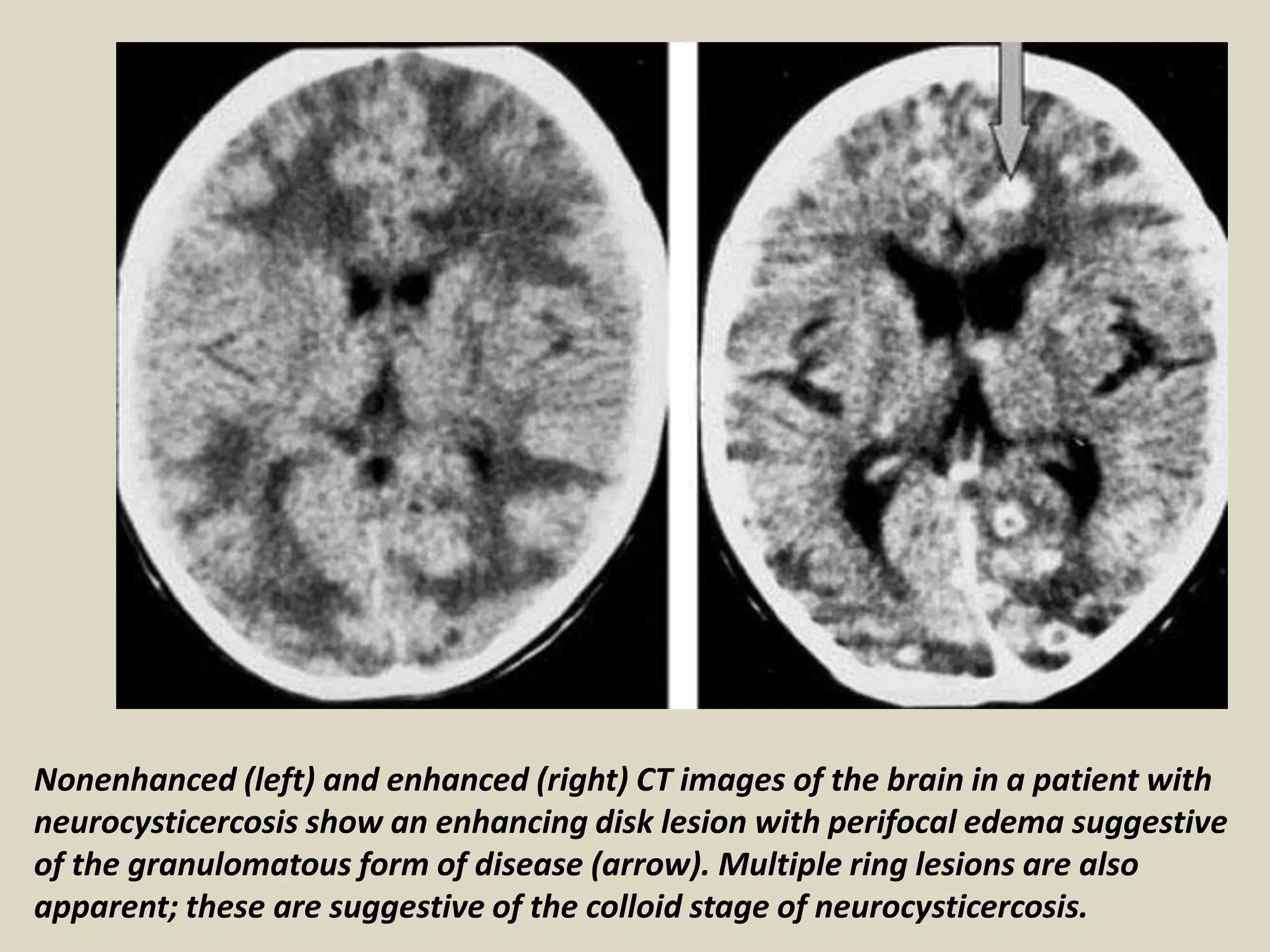 Presentation1.pptx, radiological imaging of intra cranial calcification ...