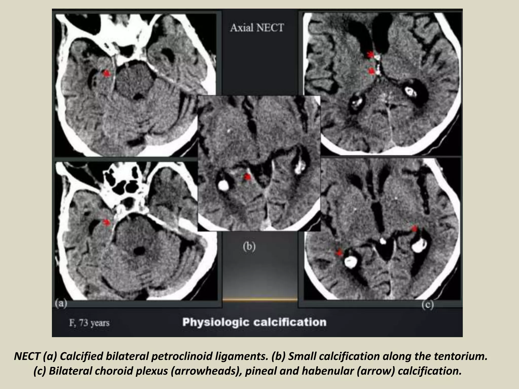 Presentation1.pptx, radiological imaging of intra cranial calcification ...