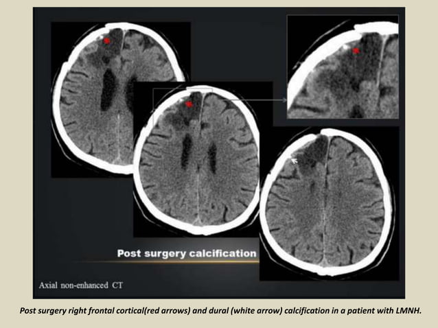 Presentation1.pptx, radiological imaging of intra cranial calcification ...