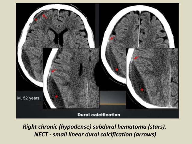 Presentation1.pptx, radiological imaging of intra cranial calcification ...