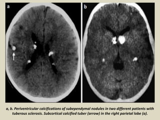 Presentation1.pptx, radiological imaging of intra cranial calcification ...