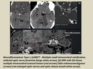 Presentation1.pptx, radiological imaging of intra cranial calcification ...