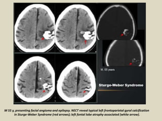 Presentation1.pptx, radiological imaging of intra cranial calcification ...