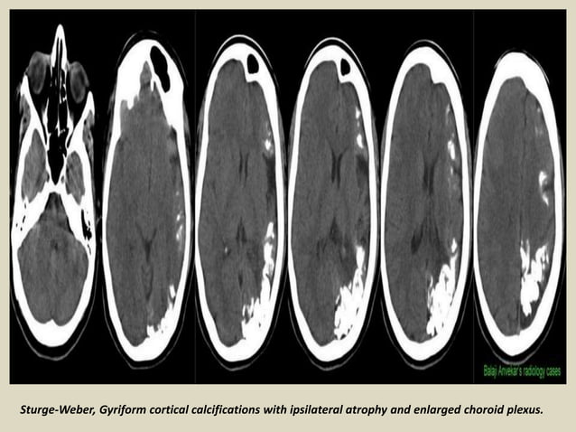 Presentation1.pptx, radiological imaging of intra cranial calcification ...