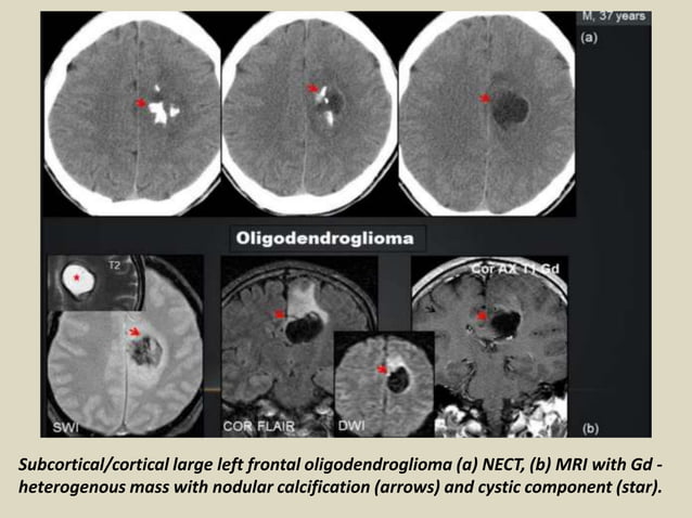 Presentation1.pptx, radiological imaging of intra cranial calcification ...
