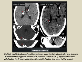 Presentation1.pptx, radiological imaging of intra cranial calcification ...