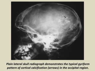 Tramline Intracranial Calcifications