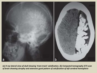 Tramline Intracranial Calcifications