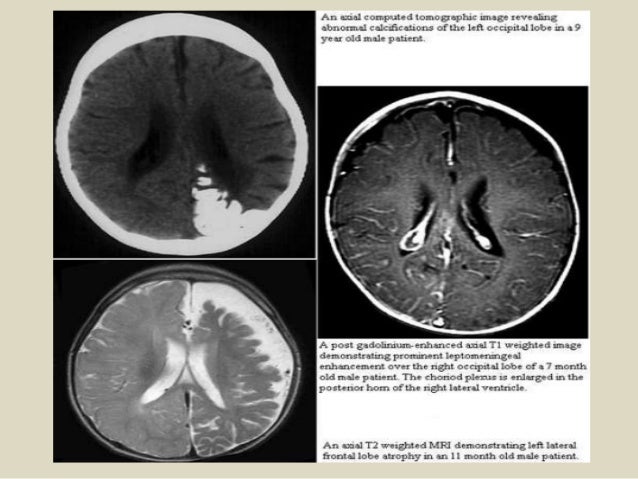Presentation1.pptx, radiological imaging of intra cranial calcificati…