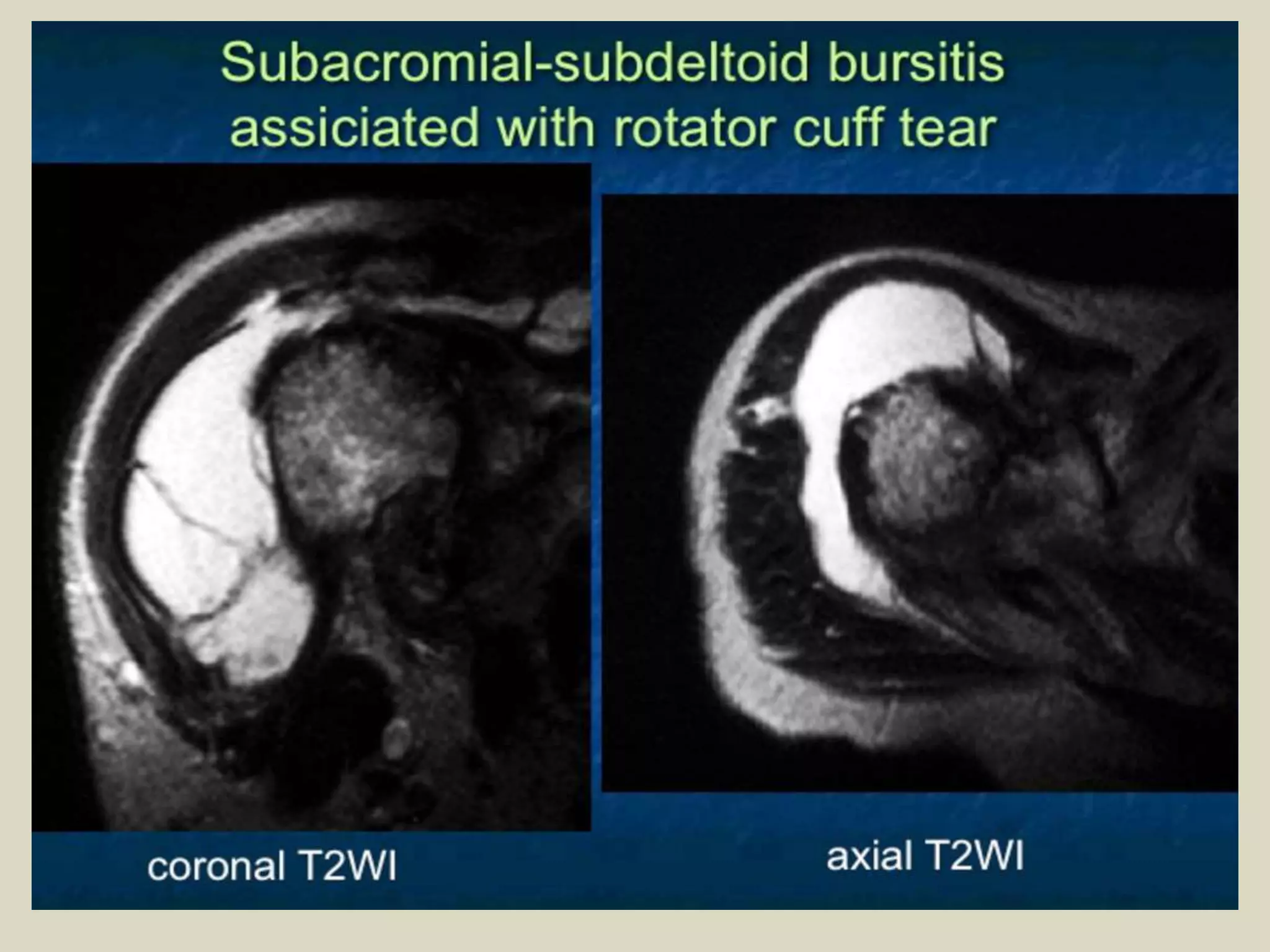 Presentation1.pptx, radiological imaging of bursae. | PPTX