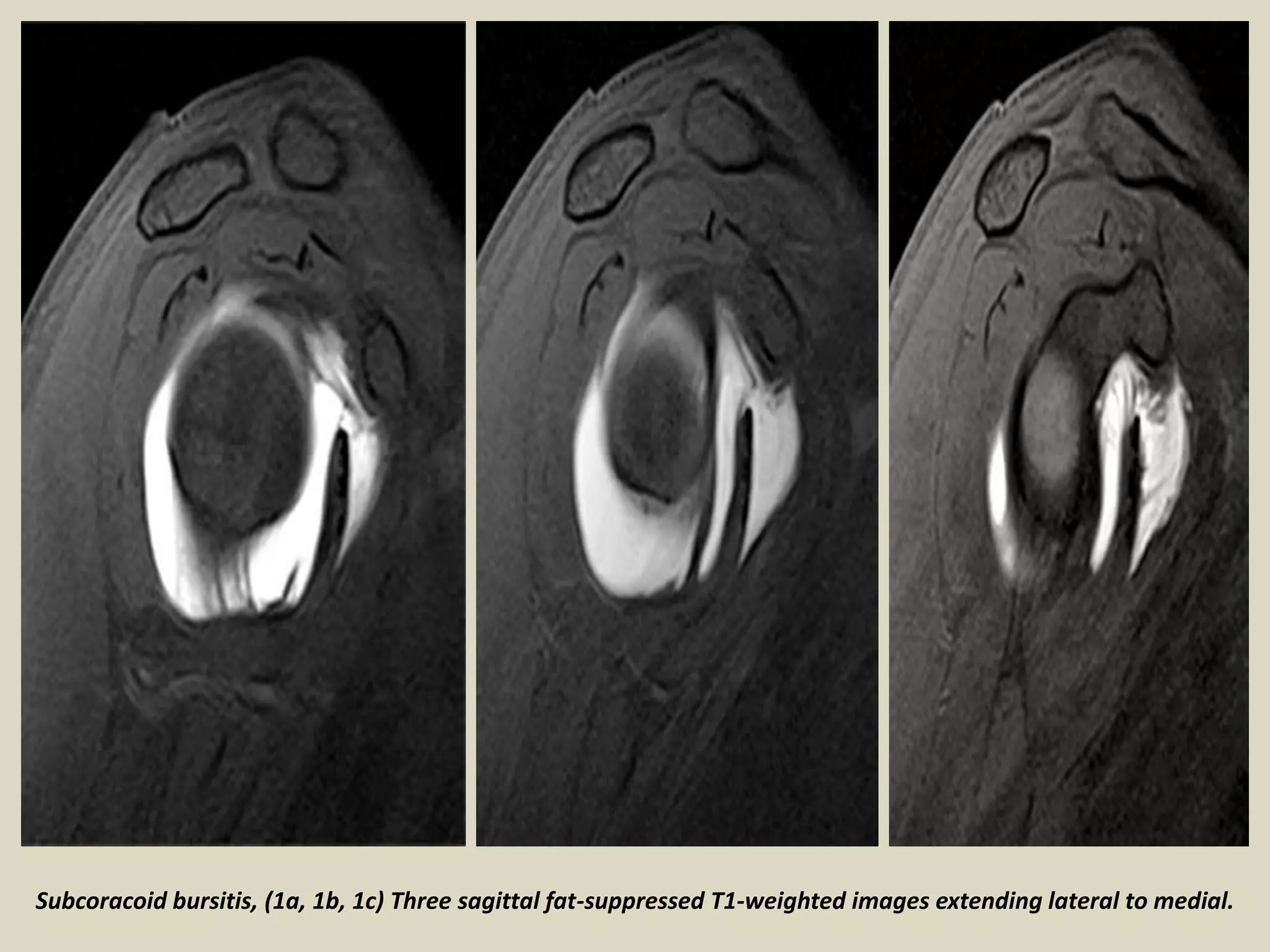 Presentation1.pptx, radiological imaging of bursae. | PPTX