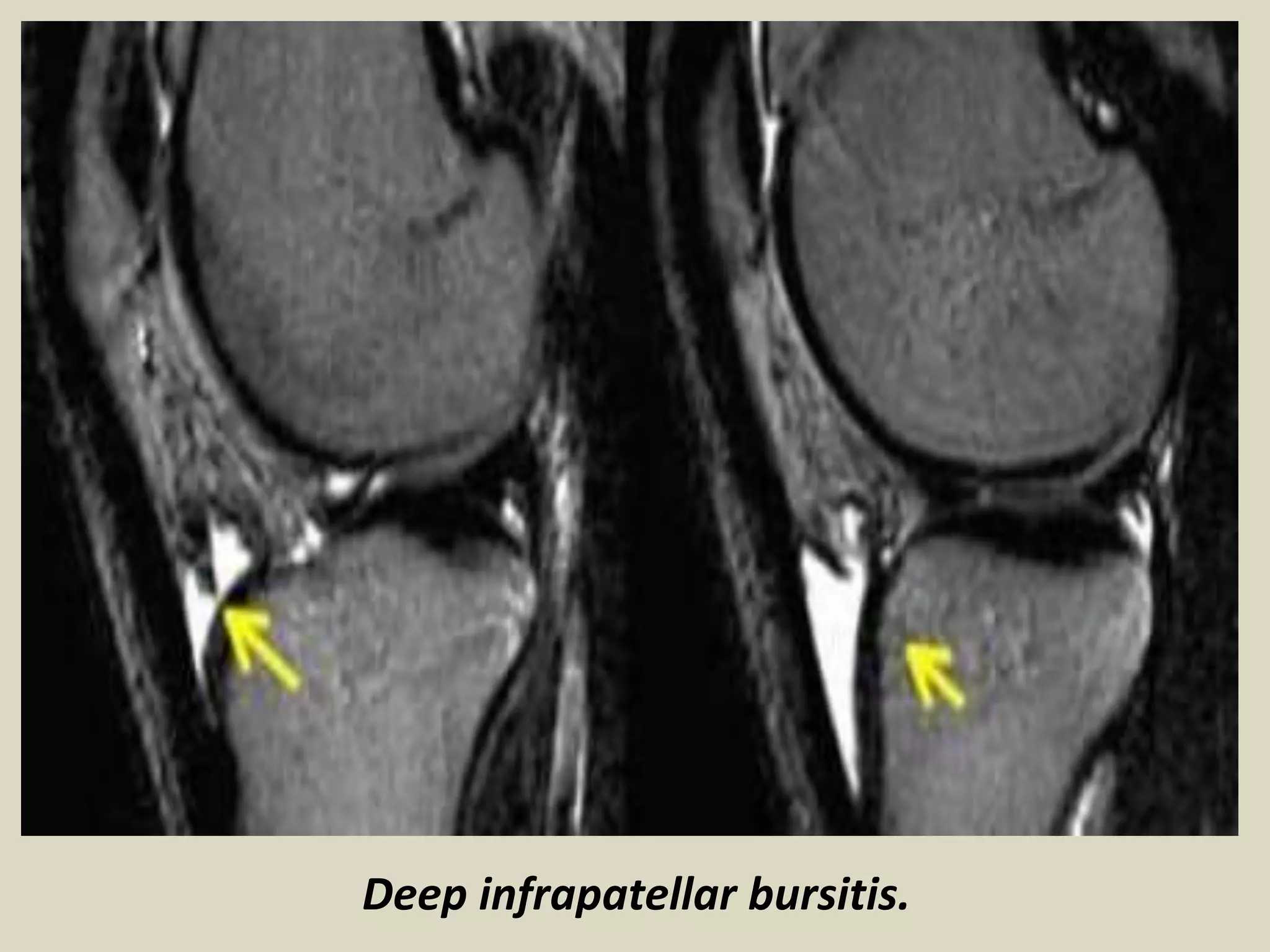 Presentation1.pptx, radiological imaging of bursae. | PPTX