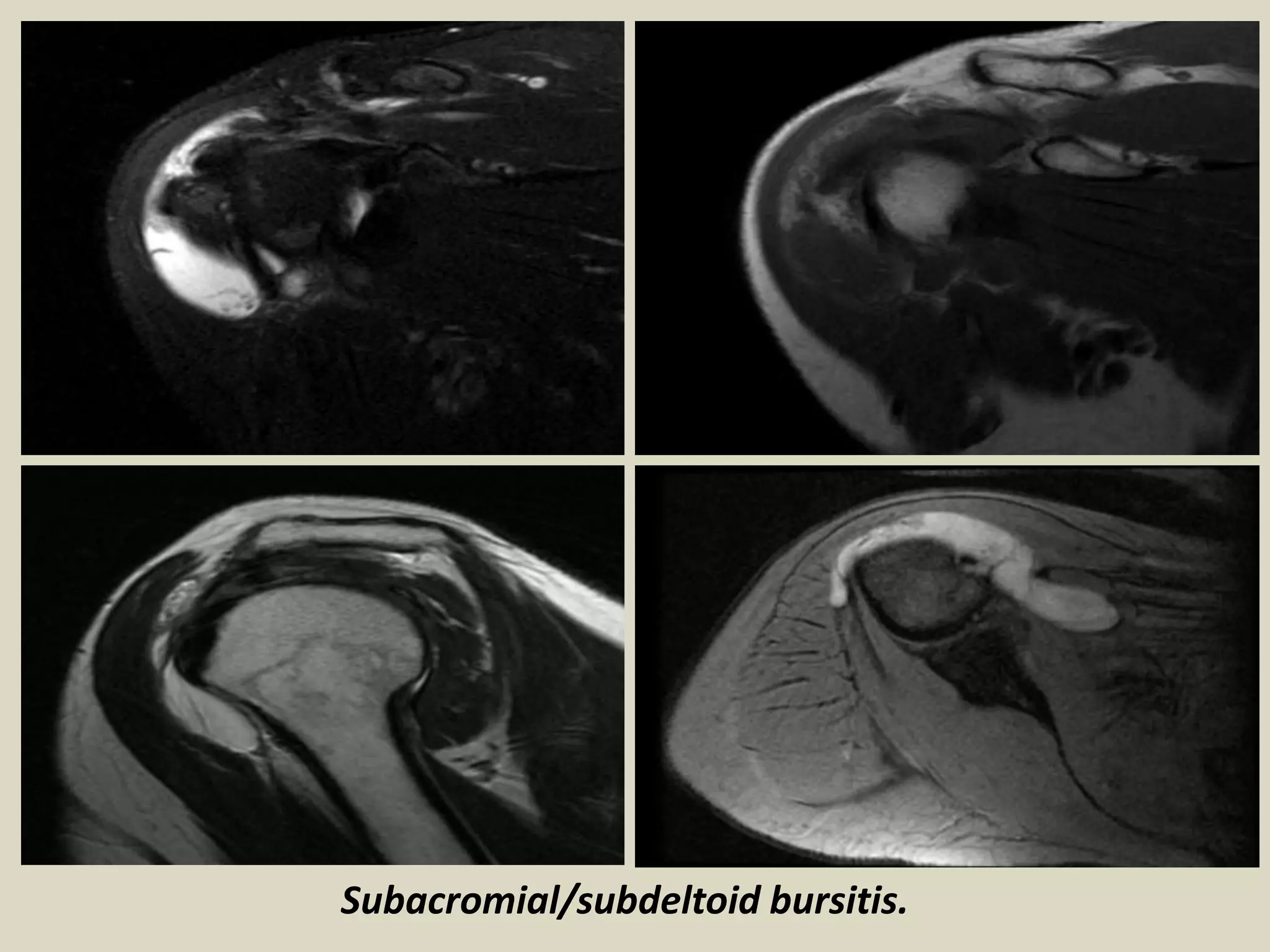 Presentation1.pptx, radiological imaging of bursae. | PPTX