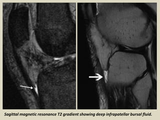 Prepatellar Bursitis Mri
