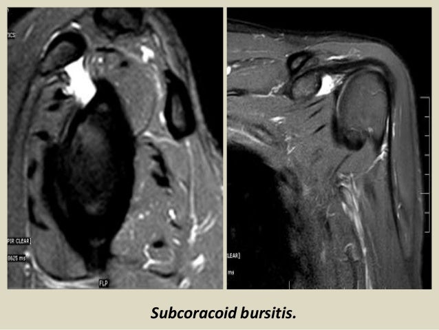 Presentation1.pptx, radiological imaging of bursae.