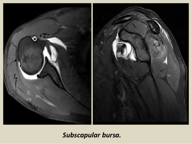 Presentation1.pptx, radiological imaging of bursae.