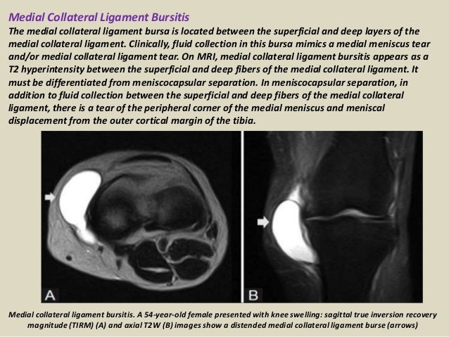 Presentation1.pptx, radiological imaging of bursae.