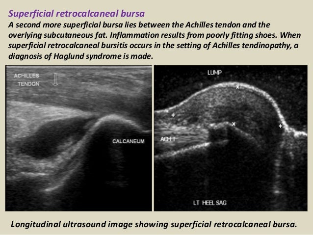 Presentation1.pptx, radiological imaging of bursae.