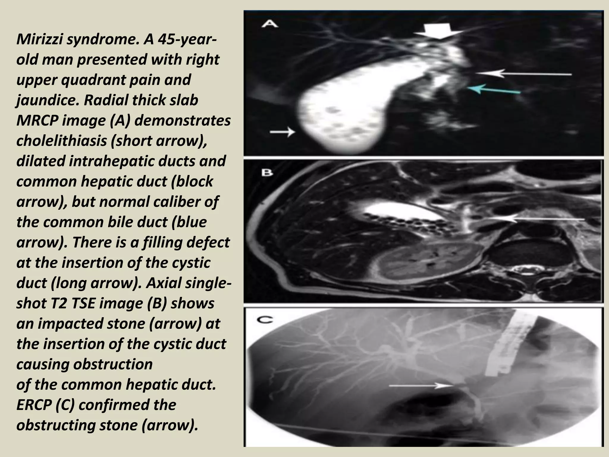 Presentation1.pptx, radiological imaging of obstructive jaundice. | PPTX