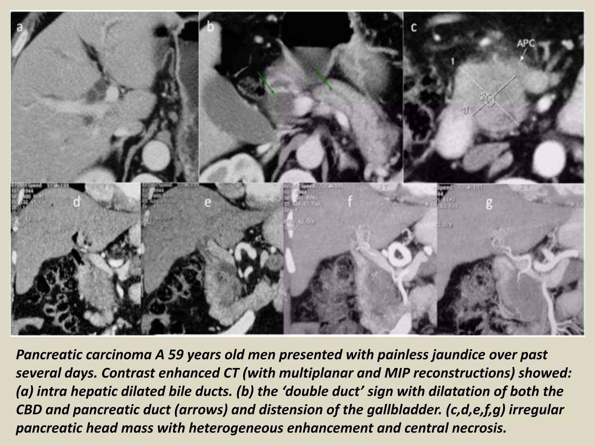 Presentation1.pptx, radiological imaging of obstructive jaundice. | PPTX