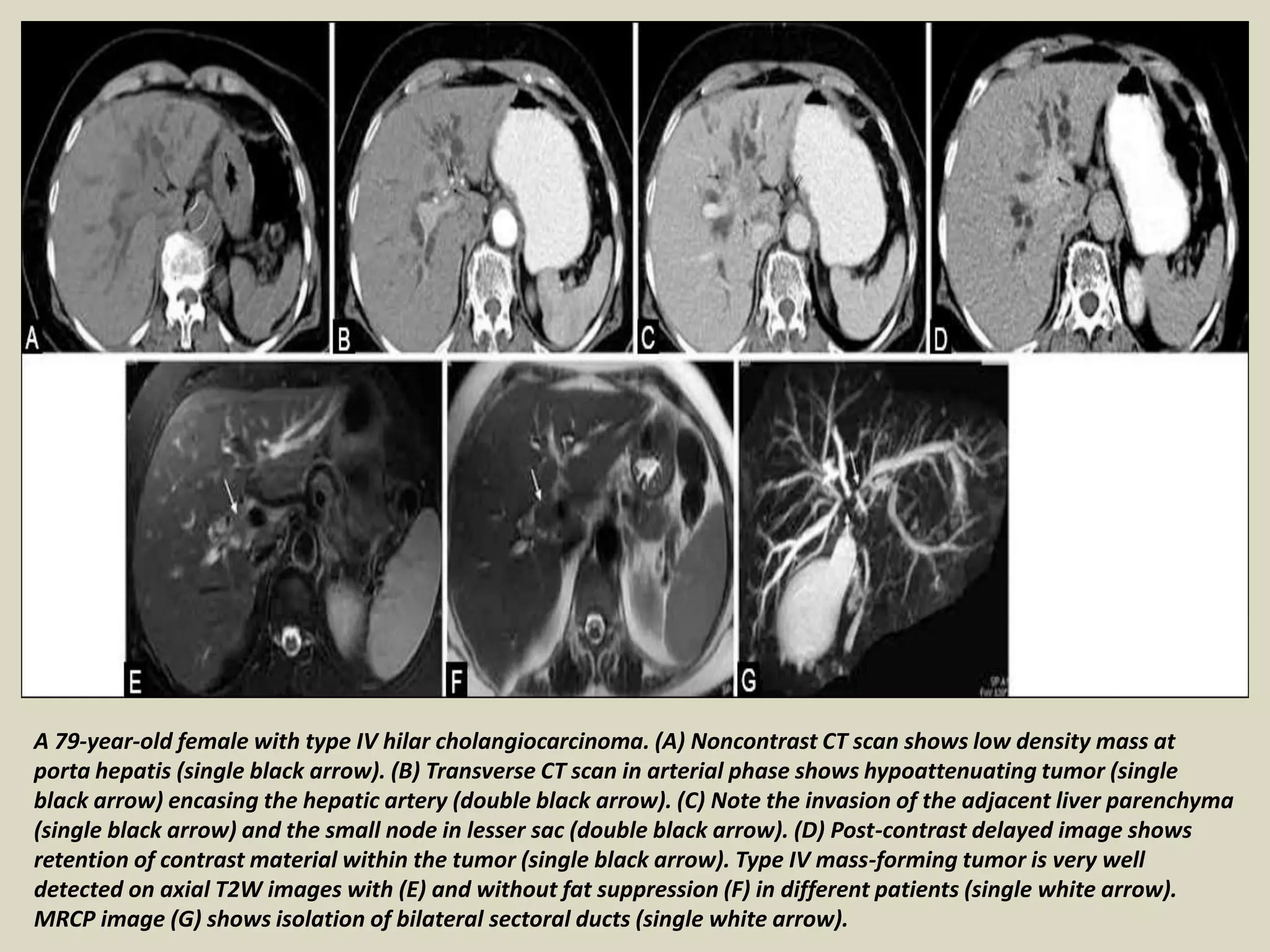 Presentation1.pptx, radiological imaging of obstructive jaundice. | PPTX