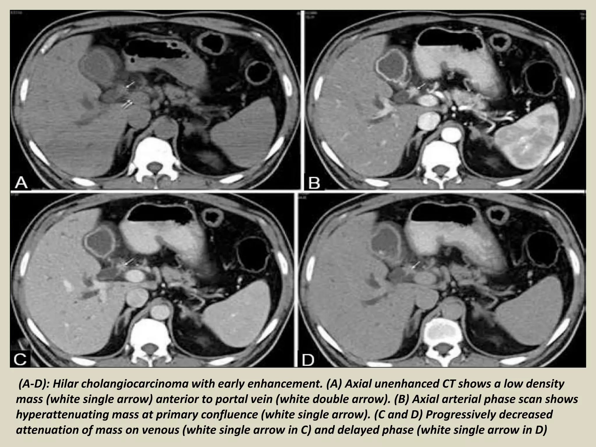Presentation1.pptx, radiological imaging of obstructive jaundice. | PPTX