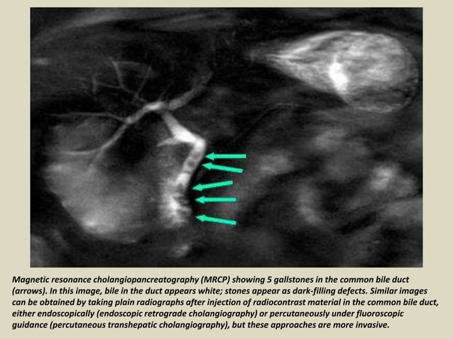 Presentation1.pptx, radiological imaging of obstructive jaundice ...