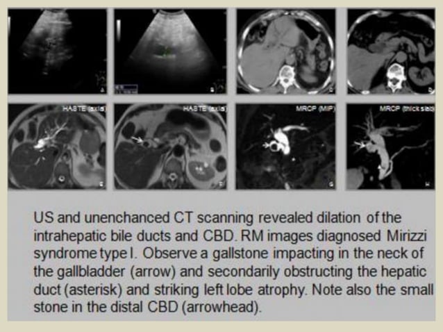 Presentation1.pptx, radiological imaging of obstructive jaundice ...
