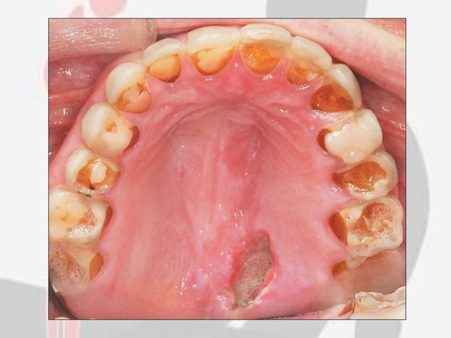 Oral manifestations of eating disorders | PPTX