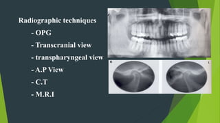 Presentation temporomandibular joint anatomy | PPTX
