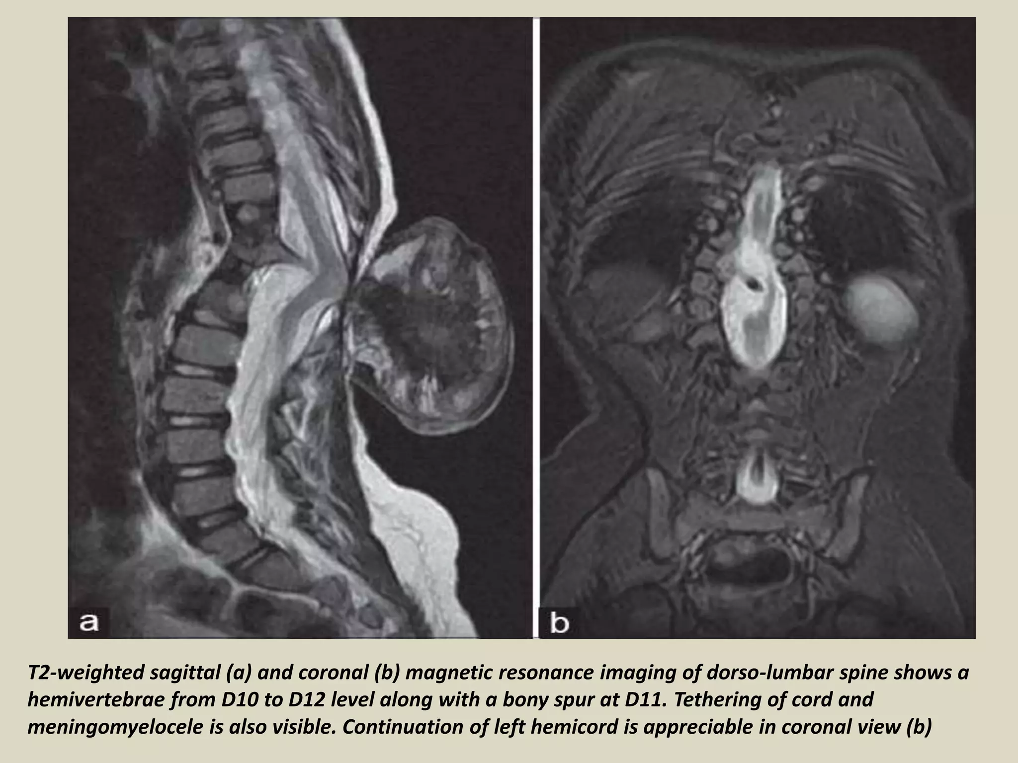 Presentation1.pptx, radiological imaging of spinal dysraphism. | PPTX