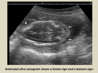 Presentation1.pptx, radiological imaging of spinal dysraphism. | PPTX