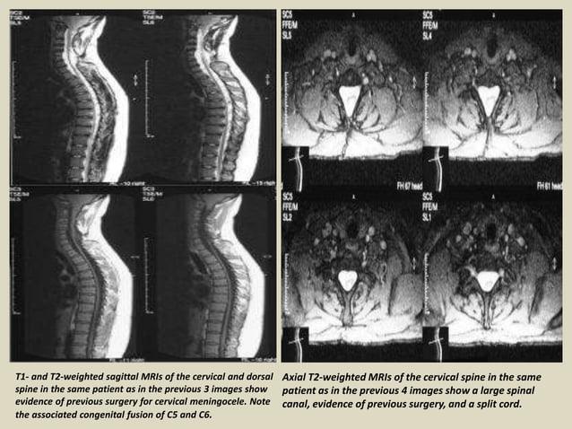 Presentation1.pptx, radiological imaging of spinal dysraphism. | PPTX ...
