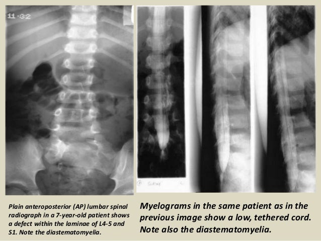 Presentation1.pptx, radiological imaging of spinal dysraphism.